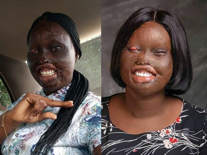 Woman Was Badly Disfigured By Acid Burns, But God Turned Things Around ...