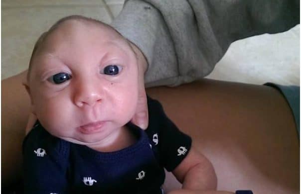 Missing Skull Miracle | Baby reaches third birthday with no skull ...