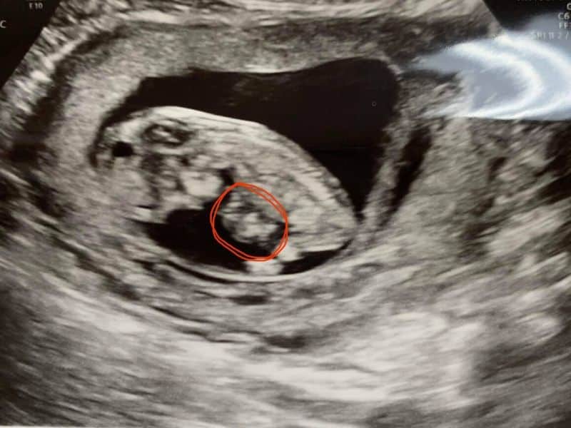 Baby With Birth Defect In Mother’s Womb Healed After Daily Prayers ...