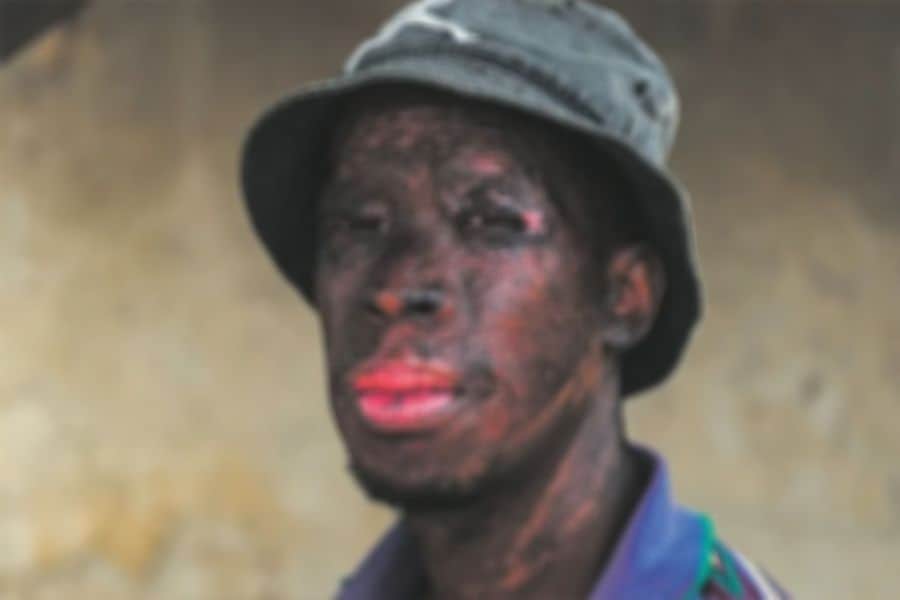 Man Sustains Burns After Running Inside Burning Shack To Save Stranger ...