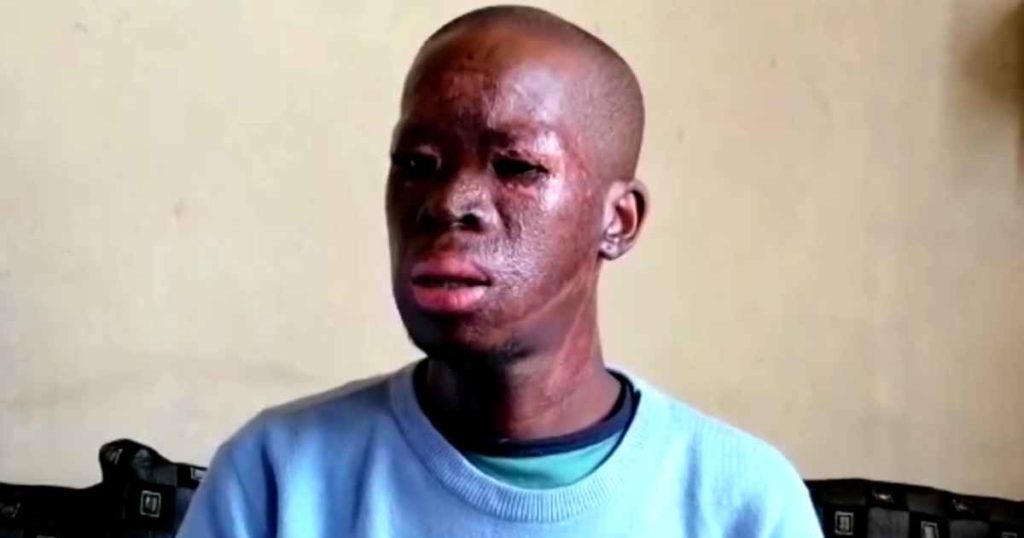 Man Sustains Burns After Running Inside Burning Shack To Save Stranger ...